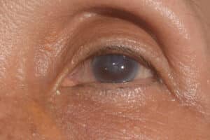 Corneal Edema After Cataract Surgery – Causes And Treatments